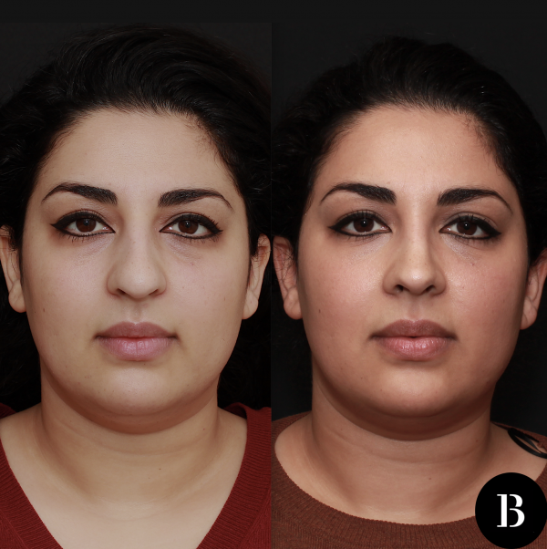 The difference between a hump, bulbous tip, deviation and wide nasal ...